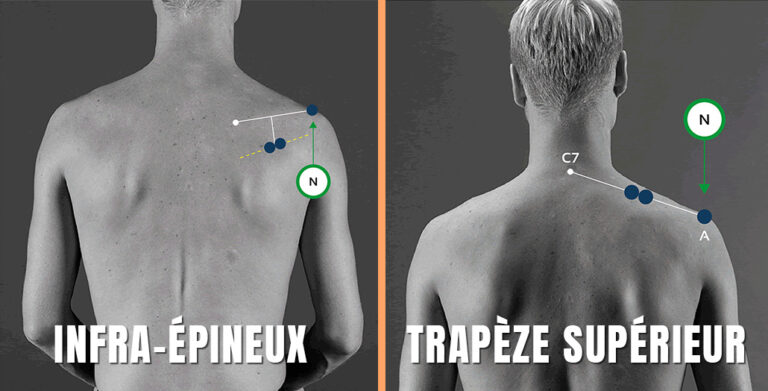 Comment rééduquer la synergie infra-épineux - trapèze supérieur