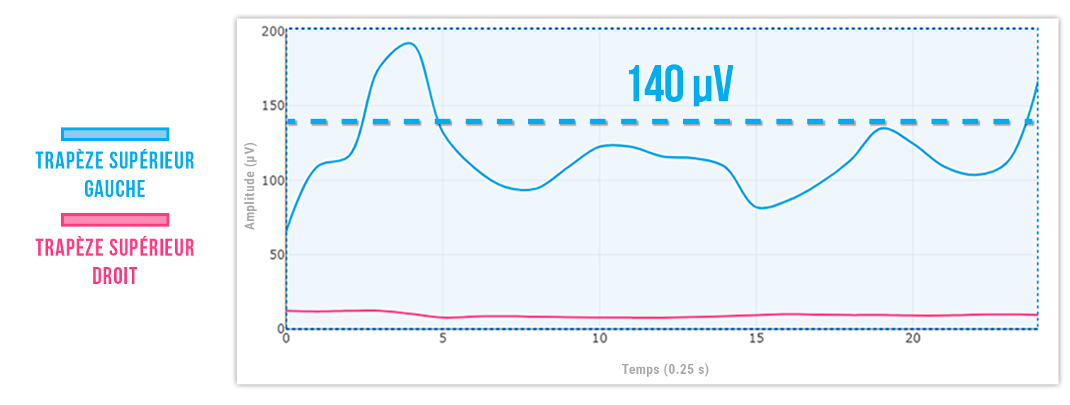 Qu'est-ce que l'excès de tonus musculaire | 3 façons de le mesurer