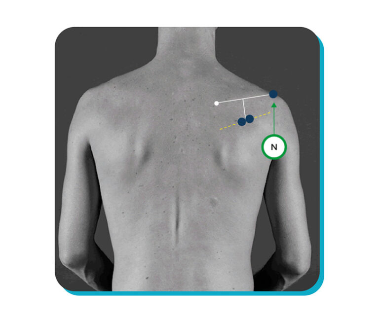 Surface Electromyography | Every Physiotherapist Should Know