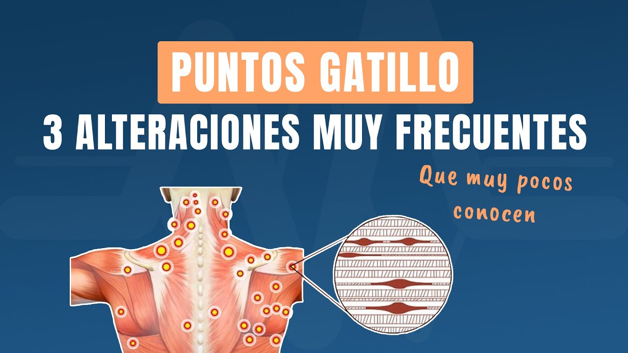 3 alteraciones en puntos gatillo que pocos conocen [+VÍDEO]